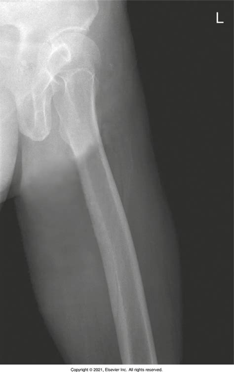 Femur Mid And Proximal Mediolateral Diagram Quizlet
