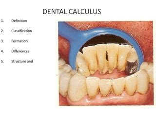 Lect 4 Dental Calculus Including Formation And Causes Pptx