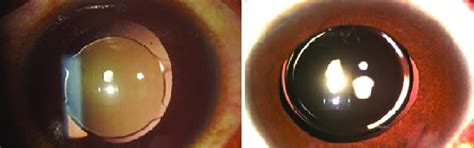 Well Centered Iris Claw Fixated Intraocular Lens A And Download Scientific Diagram