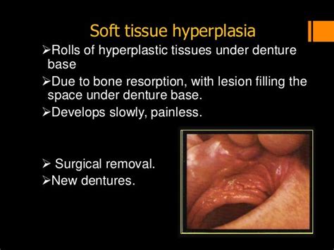 Hyperplastic Tissue