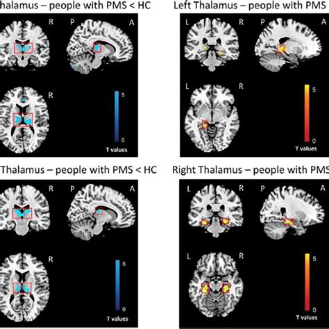Resting State Rs Functional Connectivity Fc Abnormalities In People Download Scientific
