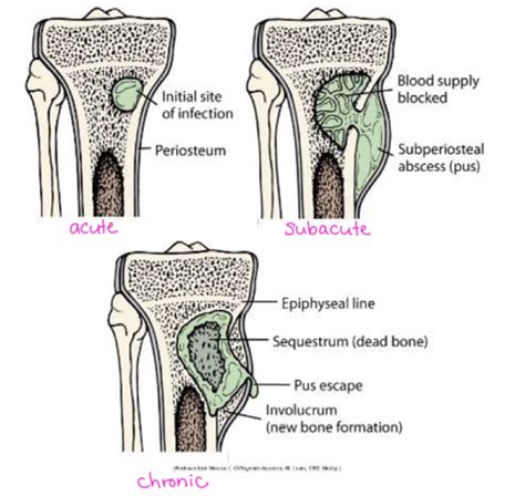 Msk Exam 2 Osteomyelitis Septic Arthritis And Malignanices Flashcards Quizlet