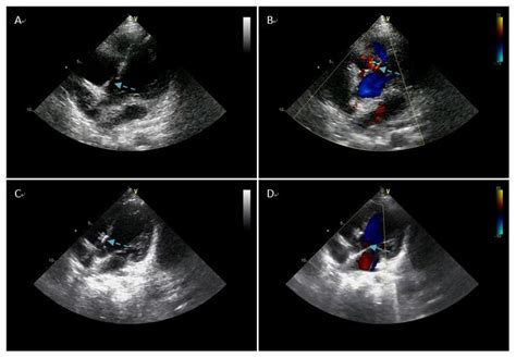 Comparison Of Tte Images At The Parasternal Five Chamber Section Before Download Scientific