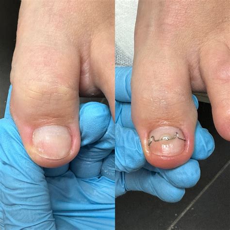 Установка скобы 3ТО современное решение для коррекции вросших ногтей