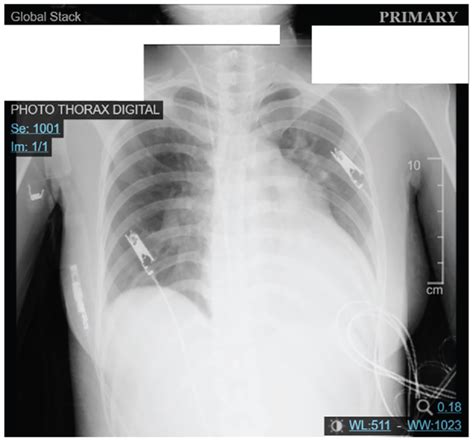 Chest X Ray Of The Patient On 28 May 2022 Revealed Cardiomegaly With