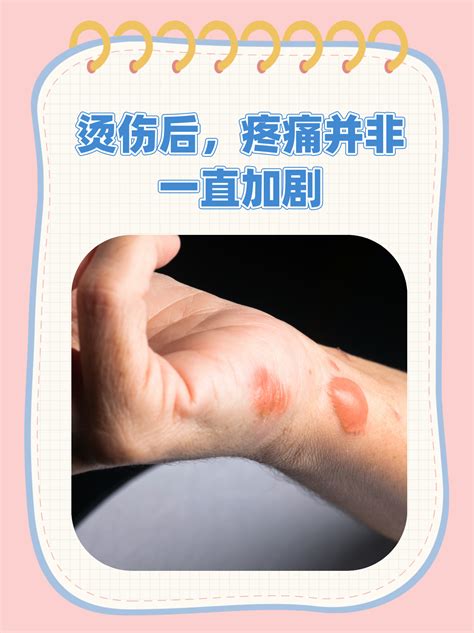 烫伤后，疼痛并非一直加剧 家庭医生在线家庭医生在线首页频道