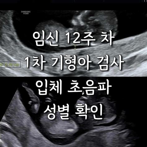 임신 12주 1차 기형아 검사 비용 입체 초음파 성별 확인 네이버 블로그
