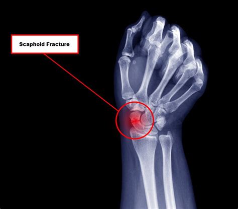 Beware Of Foosh Injuries