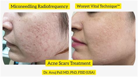 Microneedling Before And After Acne Scars