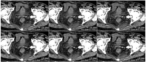 Potential Of Unenhanced Ultra Low Dose Abdominal Photon Counting Ct