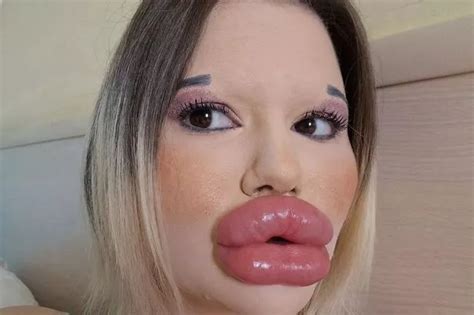 La Mujer Con Los Labios Más Grandes Del Mundo Quiere Más Relleno A