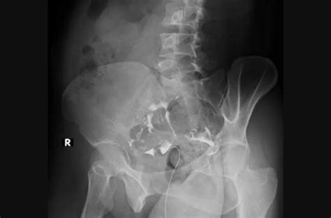 Hsg Xray Procedures Elite Diagnostics
