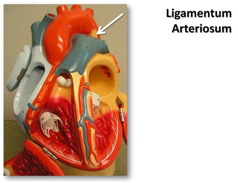 Ductus Arteriosus Ligamentum Arteriosum