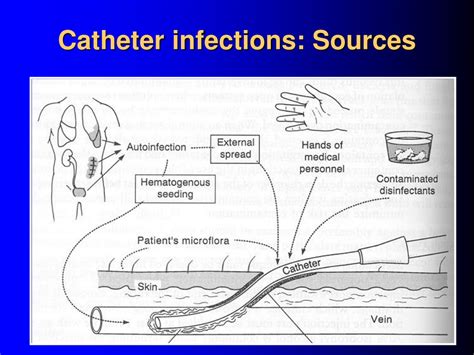 Catheter Infection Symptoms At Doris White Blog