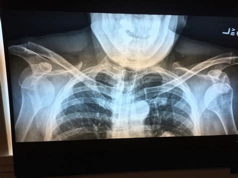 Bilateral Shoulder Dislocation Xr Jetem 2019 Jetem