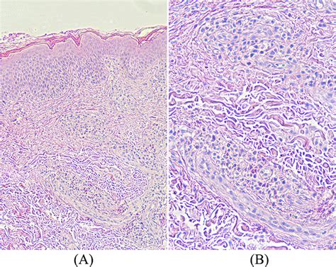 Hypereosinophilic Dermatitis Treatment With Dupilumab Btt