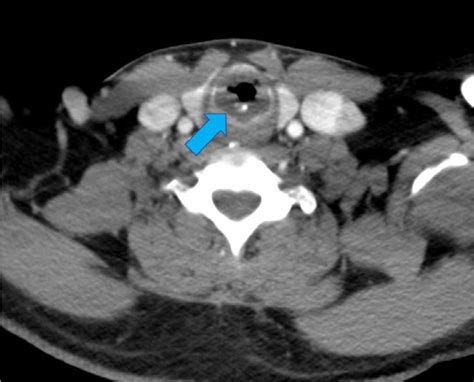 Axial Contrast Enhanced Ct Of The Neck With Prominent Circumferential