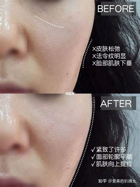 超声炮价格？超声炮做一次多少钱？能维持多长时间？超声炮有什么功效？对面部下垂有效果吗？ 知乎
