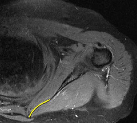 Scapulothoracic Bursitis Mri