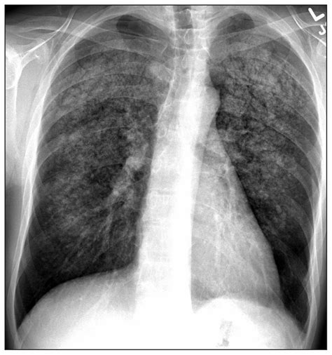 Metastatic Pulmonary Calcification In End Stage Renal Failure Cmaj