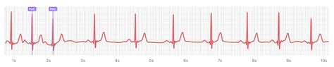 Qaly What Heart Palpitations And Ectopic Beats Look Like On Your