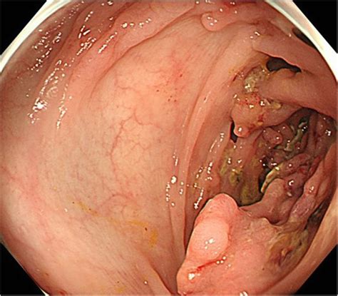 Filiform Polyposis With Sigmoid Colon Adenocarcinoma A Case Report