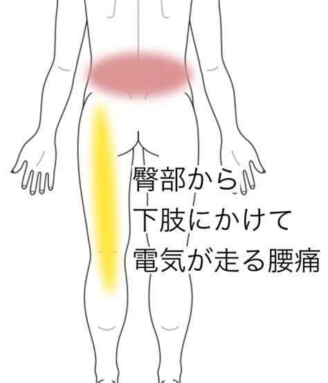 お尻からふくらはぎにかけて電気が走るような痛み｜臀部痛、腰痛のツボ｜ツボネット 鍼灸の症例が検索できるツボ辞典