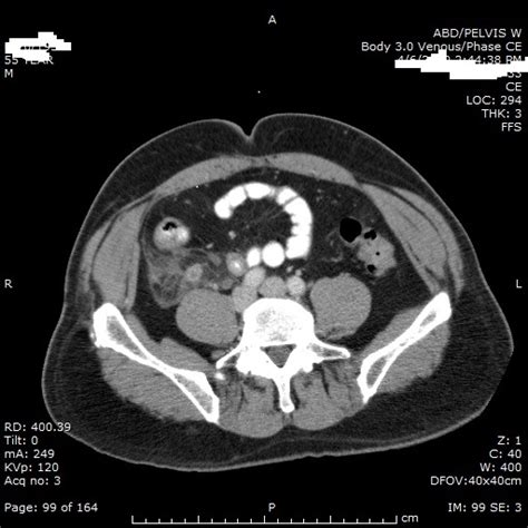 Appendix Stump Appendicitis 1436 Stump Appendicitis 2 Surgery Photos