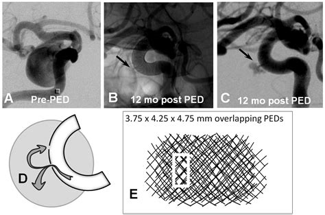 Pipeline Device Aneurysm Selection