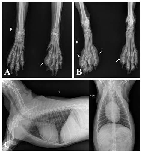 Hypertrophic Osteopathy Concurrent With An Aberrant Right Subclavian