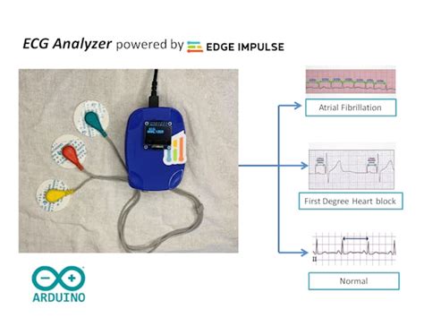 [need advise] ecg analyzer help edge impulse forum