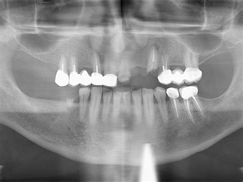 Zygomatic And Pterygoid Implants 🥇 Temecula Facial Oral Surgery