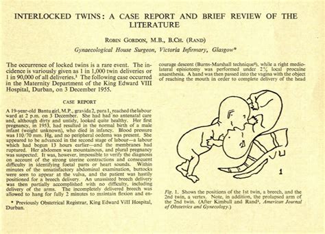 Interlocked Twins A Case Report And Brief Review Of The Literature Docslib