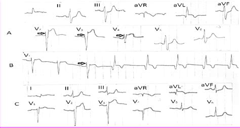 Lafb Ecg