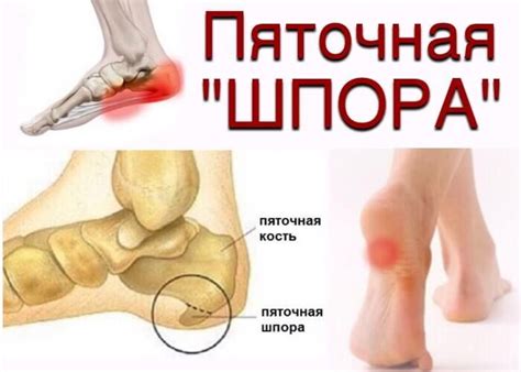 Пяточная шпора симптомы и лечение в домашних условиях лечение шпоры