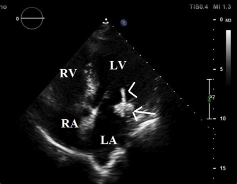 A Mitral Annular Calcificationrelated Calcified Amorphous Tumor In End