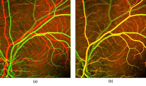 Analysis Of Video Retinal Angiography With Deep Learning And Eulerian Magnification