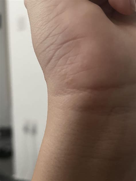 Post Or Active Scabies Please Help Rscabies