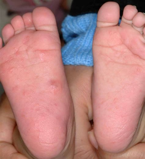 Scabies On Foot Top Sellers