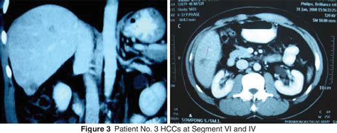 Figure 3 From Combined Hepatectomy And Radiofrequency Ablation For Multifocal Hepatocellular