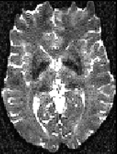 Micsi Denoising