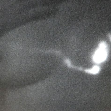 A Breast Reconstruction With Diep Flap At One Year Follow Up B