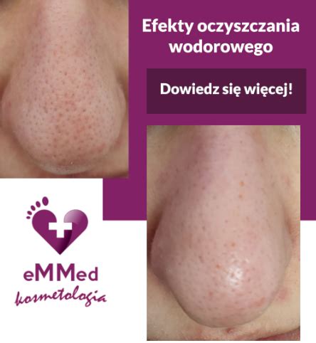 Oczyszczanie wodorowe twarzy Sekret pięknej i zdrowej skóry eMMed
