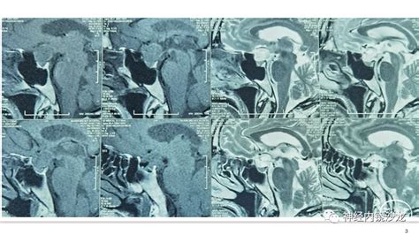 【病例】内镜经鼻经鞍结节蝶骨平台入路颅咽管瘤切除术一例（附视频） 脑医汇 神外资讯 神介资讯