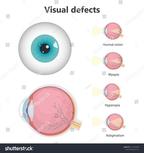 Ophthalmic Concept Eye Defects Normal Vision Stock Vector Royalty Free Shutterstock