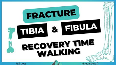 Walking After Broken Tibia And Fibula Physio Tips For Recovery