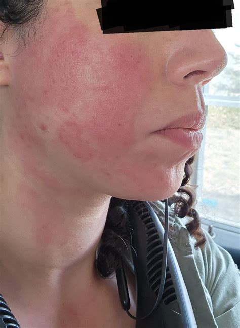 My Derm Says This Is Chronic Idiopathic Urticaria Hives 2 8 Times