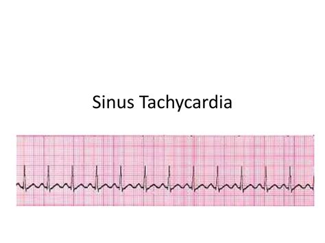 Sinus Tachycardia Sinus Tachycardia Pptx