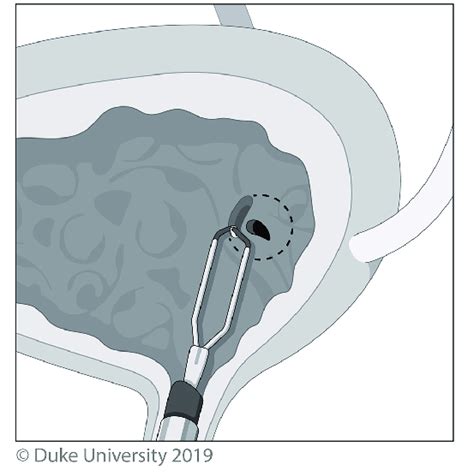 The Endoscopic Pluck Technique Here The Collins Knife Is Used To