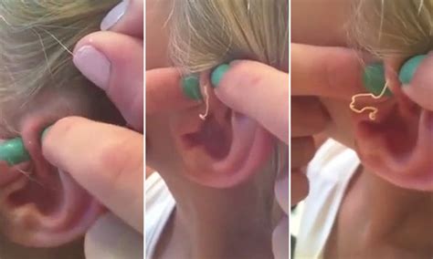 Ear Cysts Popping Ear Cysts Popping